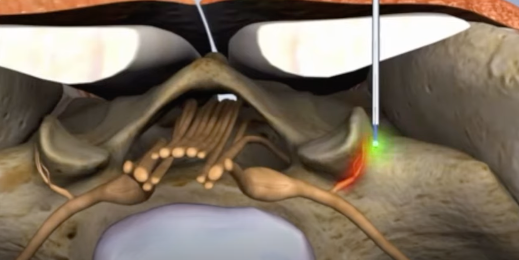 The Benefits of Laser Facet Nerve Ablation: A Modern Solution for Back ...